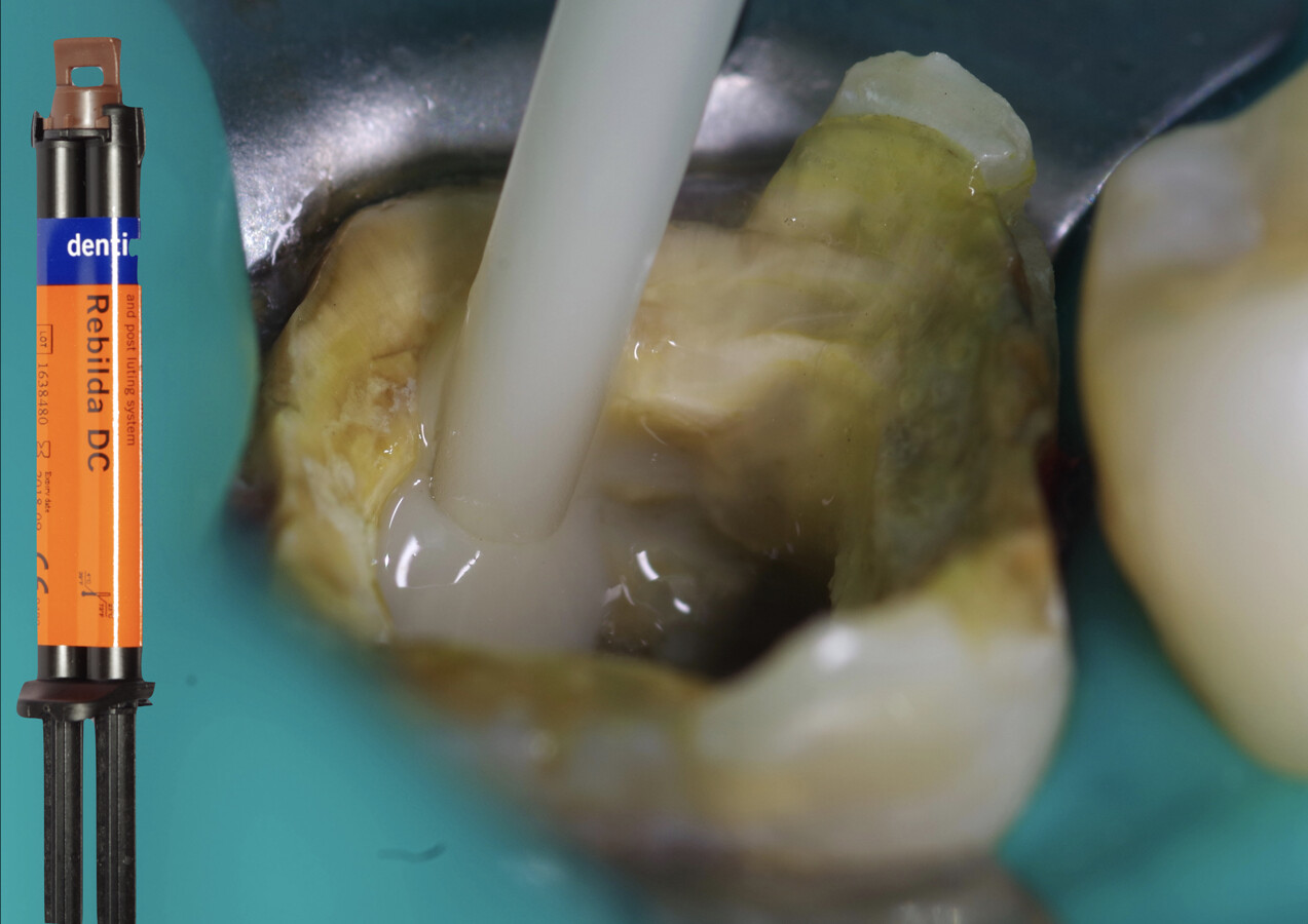 Chairside fabrication of an endocrown