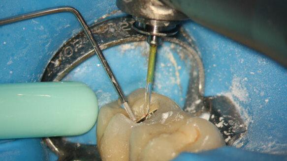 Dental News - PIPS and retreatment