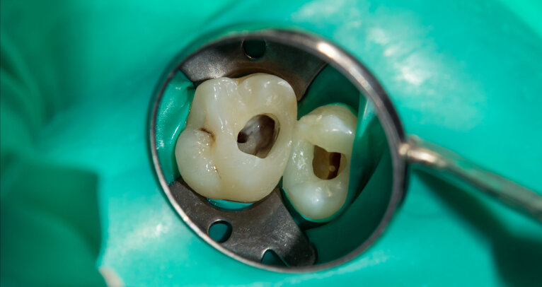 Shaping a Type V mandibular premolar with VDW.ROTATE
