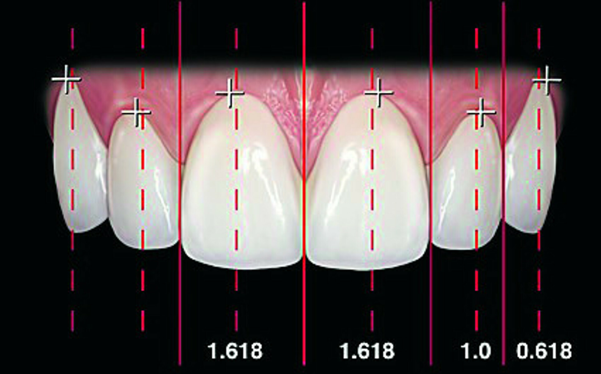 Orthodontic management of maxillary lateral incisors agenesis