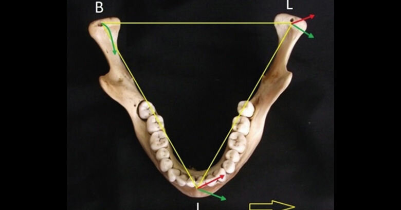Condylar retrusion on the horizontal plane associated with retrusive ...