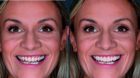 Dental News - Utilising smile design software and CAD/CAM for creating ...