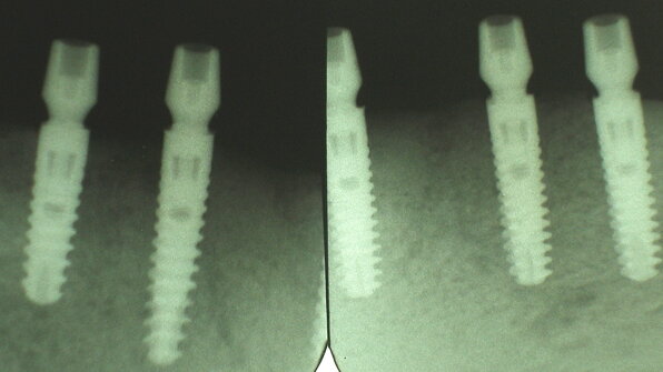 The Ankylos-SynCone Overdenture System: The biology, diagnosis and ...