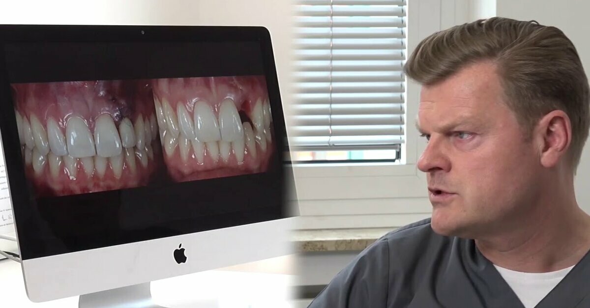 Immediate restoration in the esthetic zone using bone level tapered ...