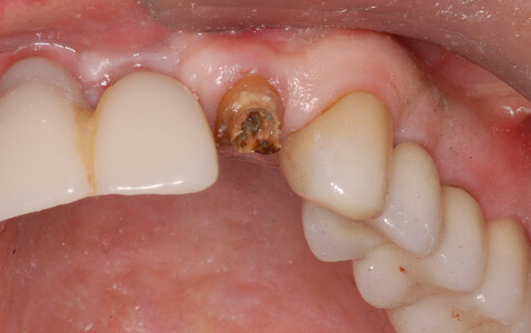 Guided applications for partial extraction therapy