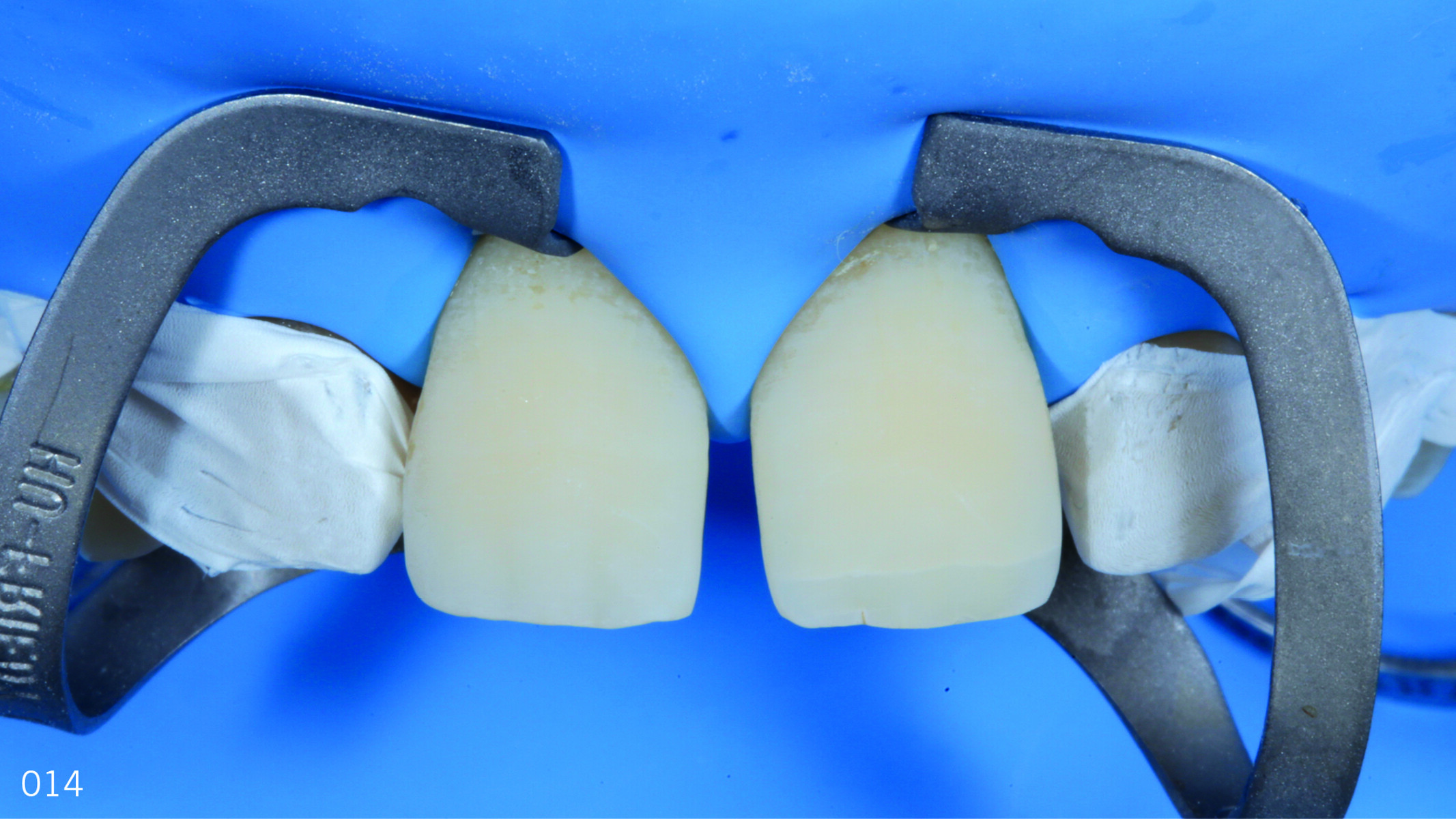 DT News - International - Extremely minimally invasive mock-up-guided ...