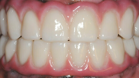 Dental News - Edentulous arch restored with BruxZir Full-Arch Implant ...