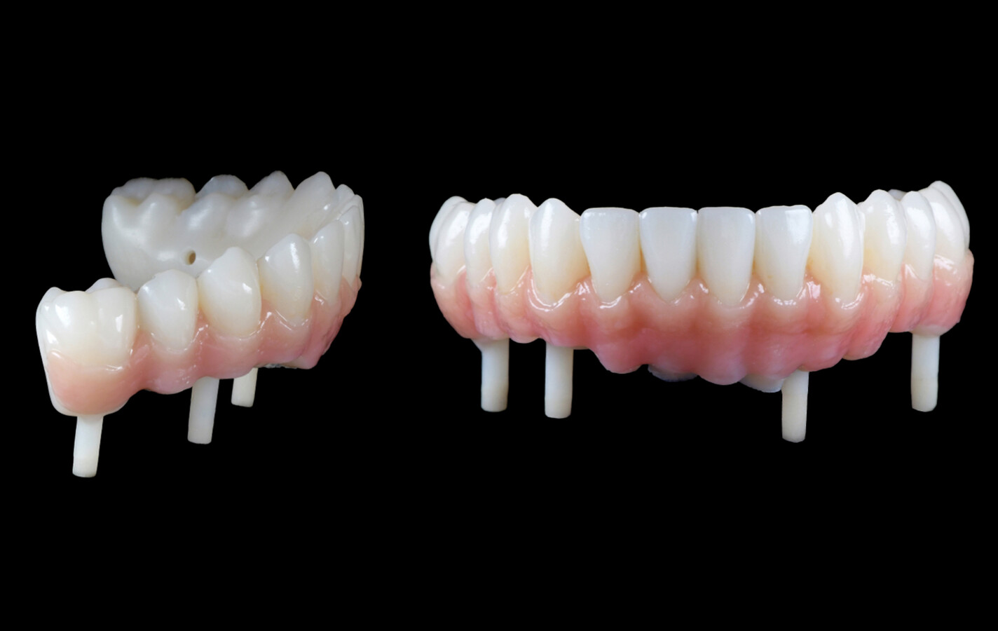 Implant treatment of the fully edentulous patient