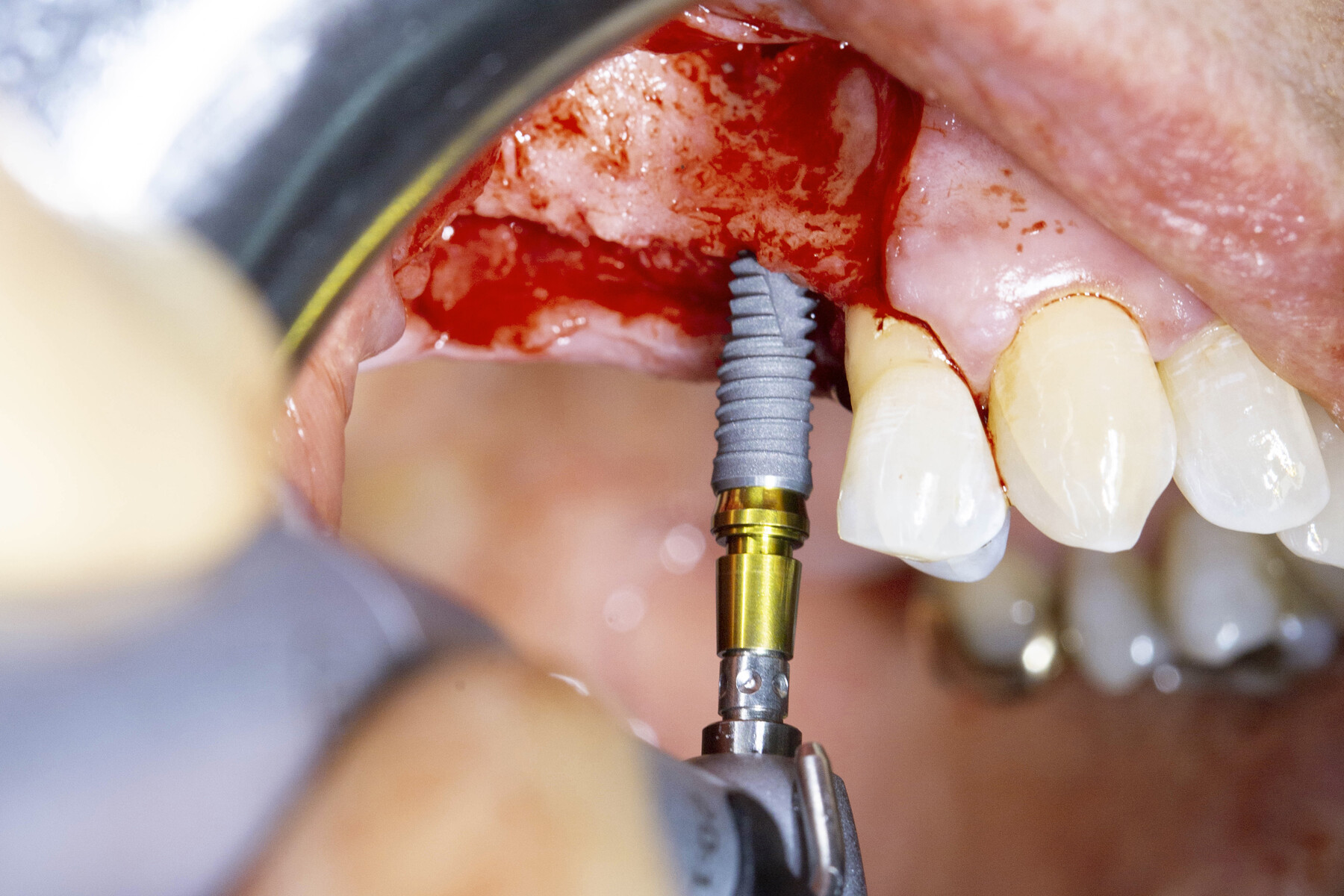 Screw-retained restoration
