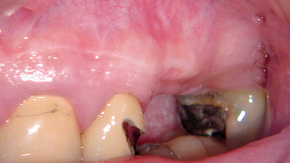 Apical microsurgery: sutures, suturing techniques (Part 6)