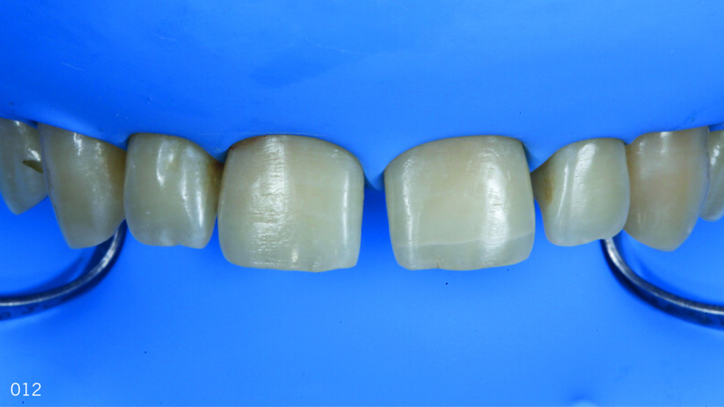DT News - International - Extremely minimally invasive mock-up-guided ...