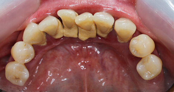 Plaque toothpaste reduced risk stroke heart