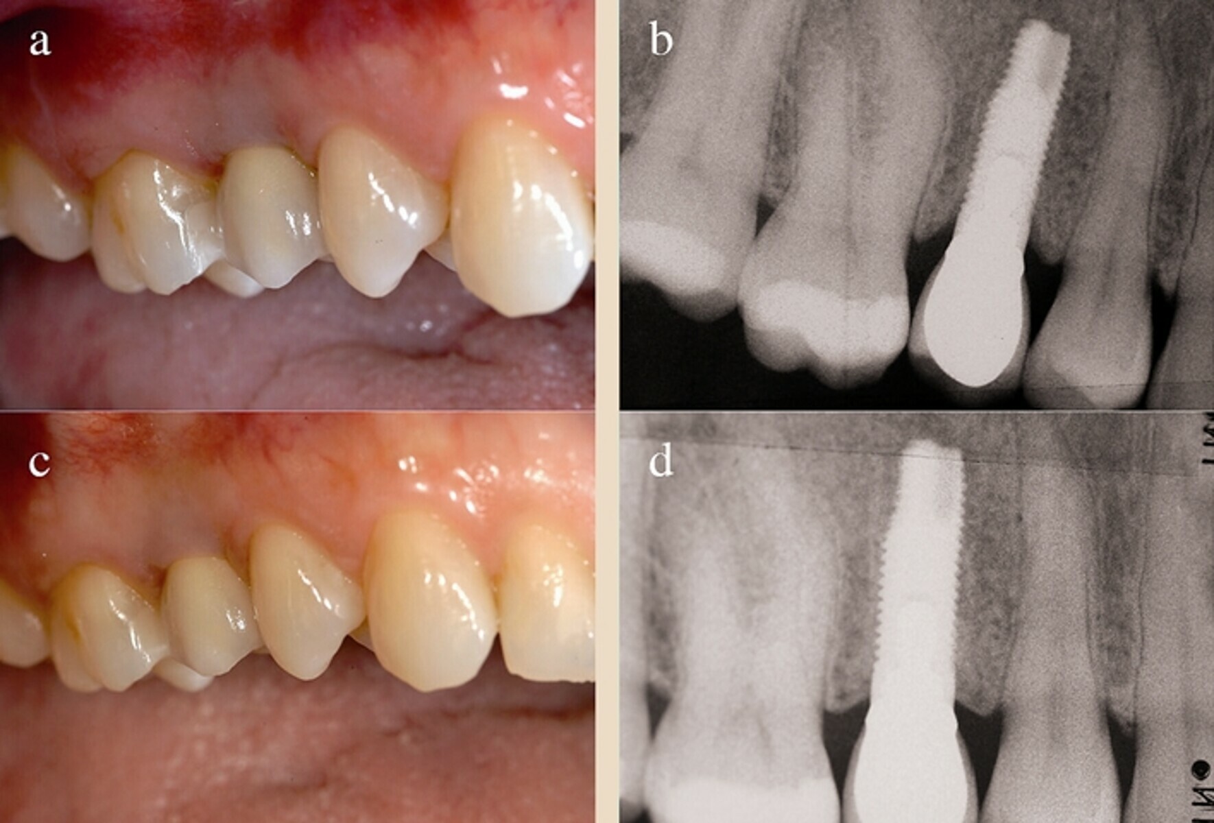 Neoss Implantat System