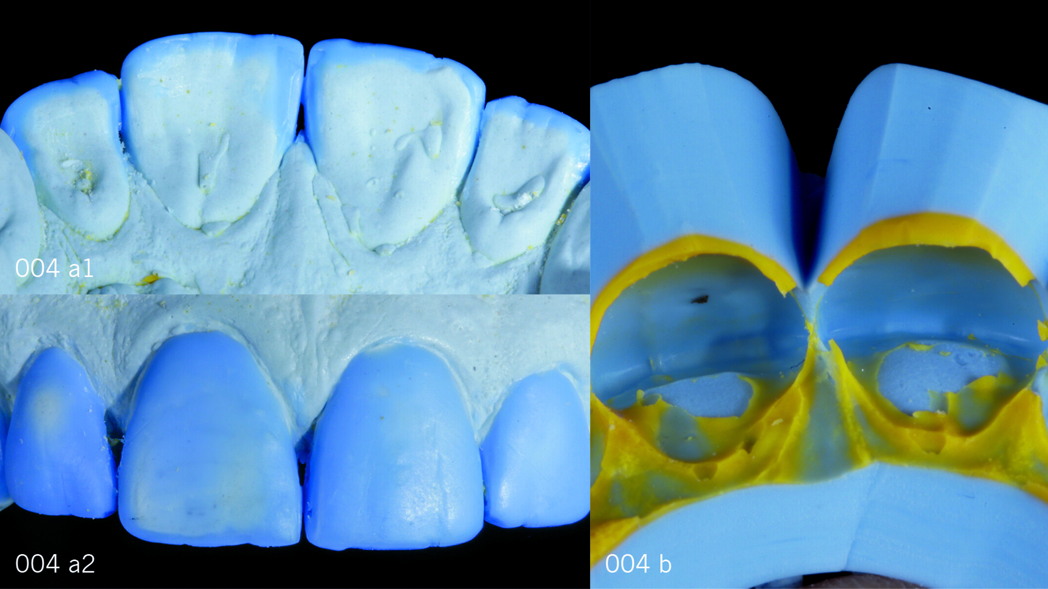 DT News - International - Extremely minimally invasive mock-up-guided ...