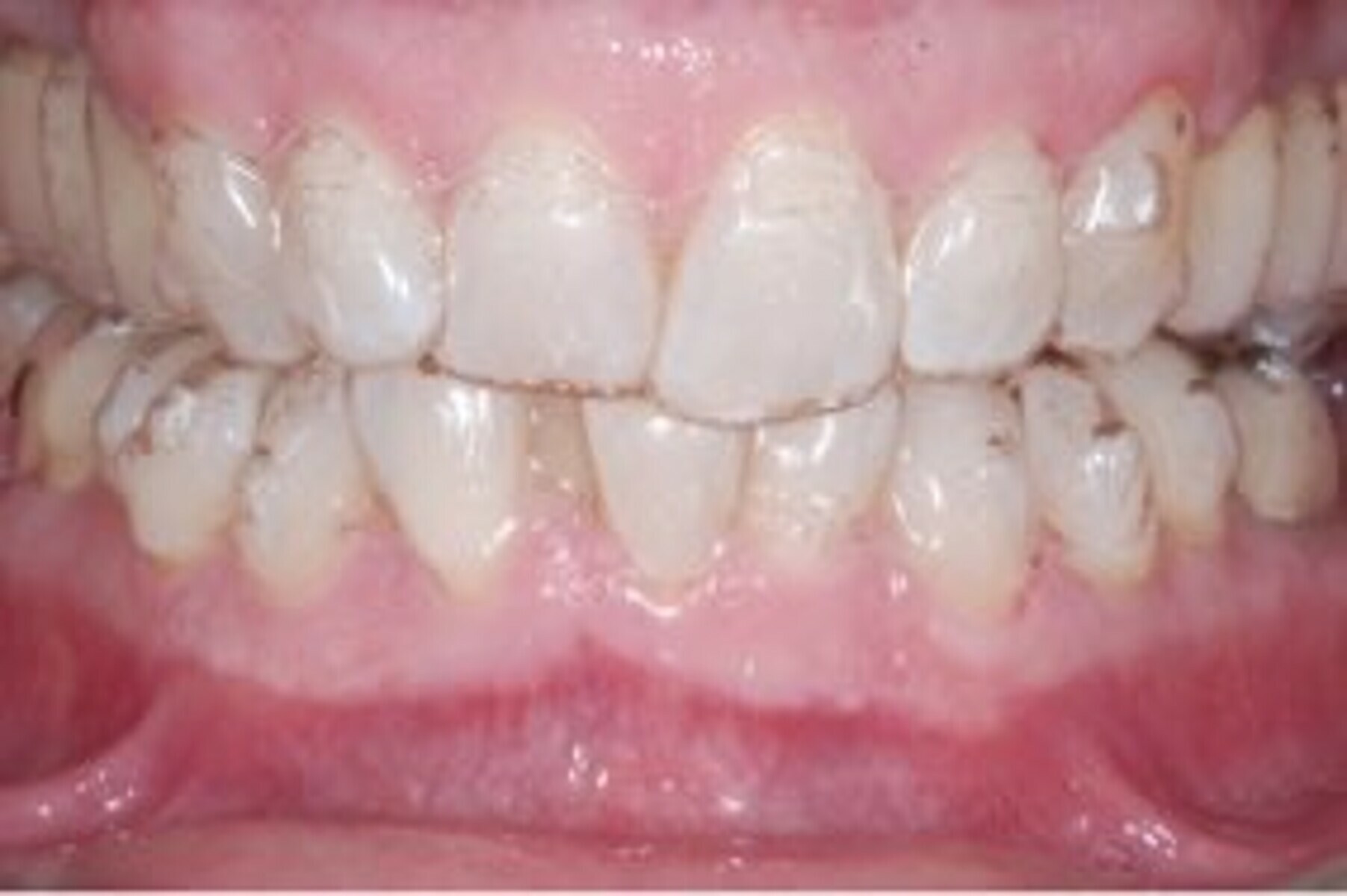 Proper curve of Spee levelling