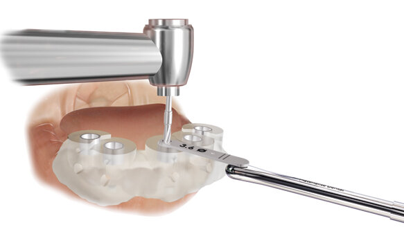 DT News - US - Materialise Dental triples its range of Universal ...