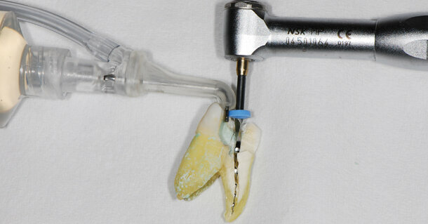 Dental News - Improving endodontic success through use of the EndoVac ...