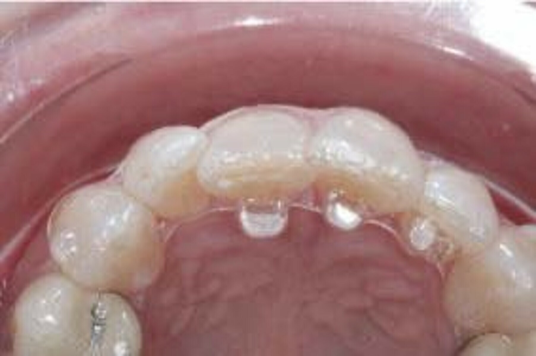 Proper curve of Spee levelling