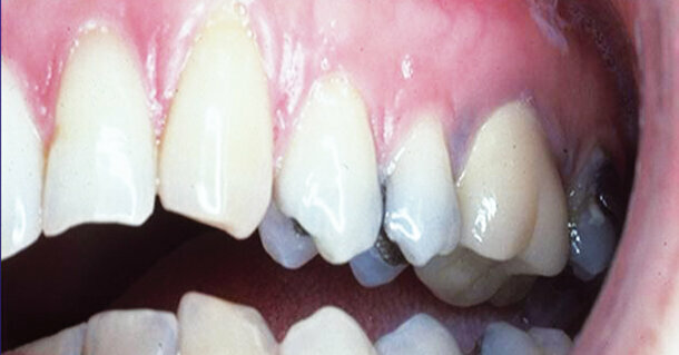 Dental News - Root recession: Aesthetic and predictable elimination