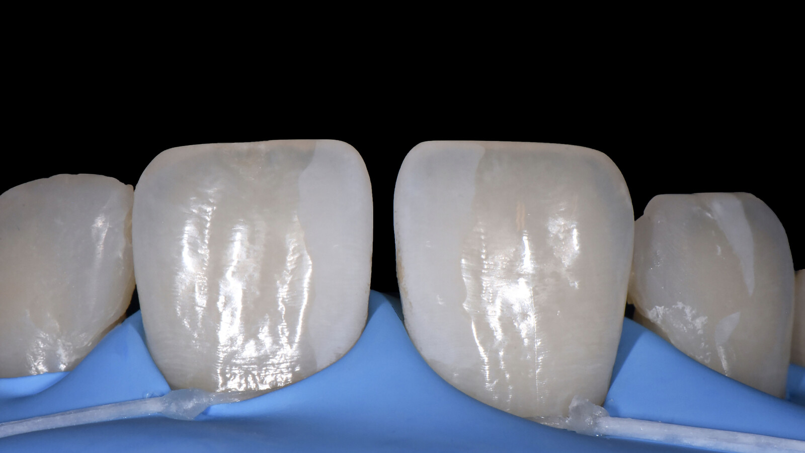 Diastema closure using a direct two-matrix technique