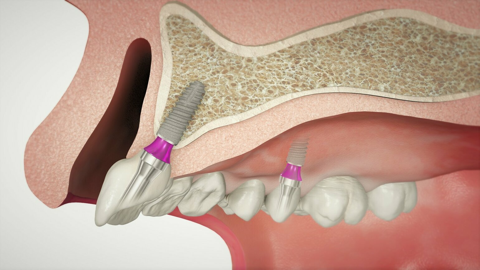 DT News - UK - How the SKY fast & fixed implant system lives up to its name