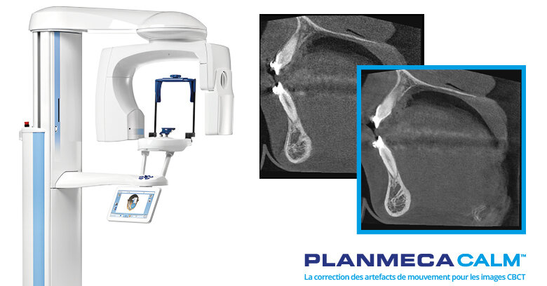 Des résultats d'imagerie exceptionnels avec les appareils CBCT de Planmeca
