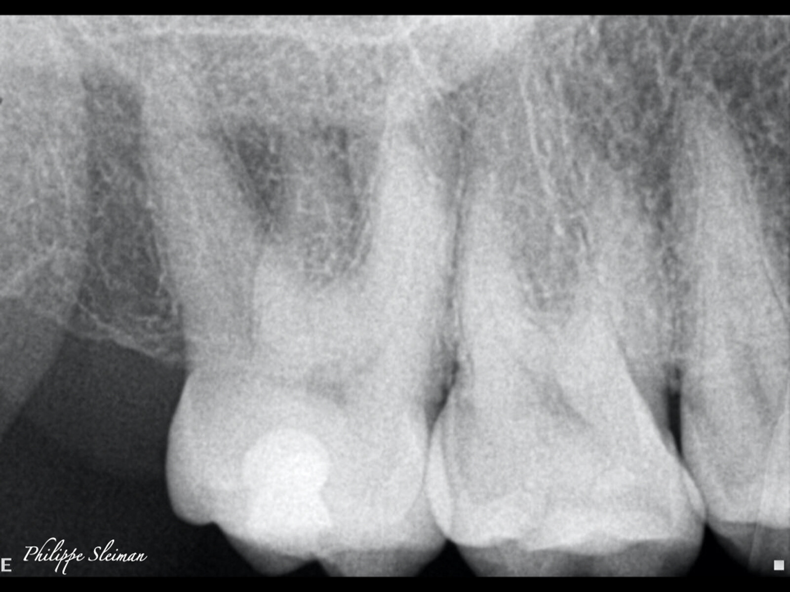 Clinical management of maxillary second molar root canal therapy in ...