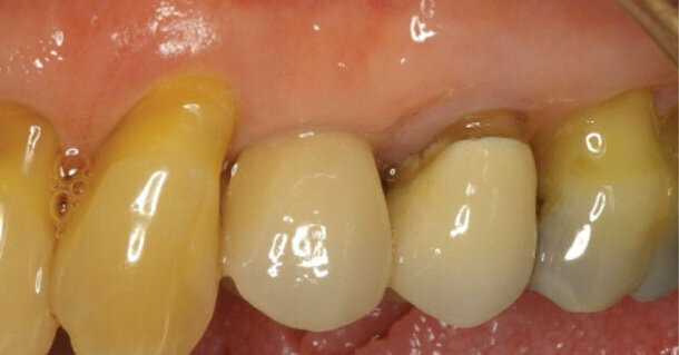 Dental News - Esthetics with implants: Platform switching