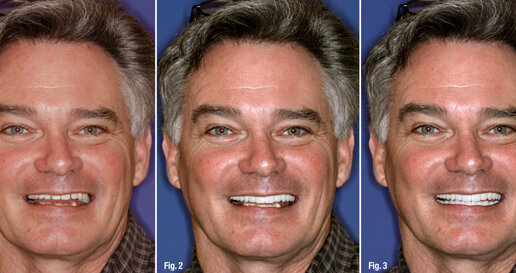 Smile analysis and photoshop smile design technique