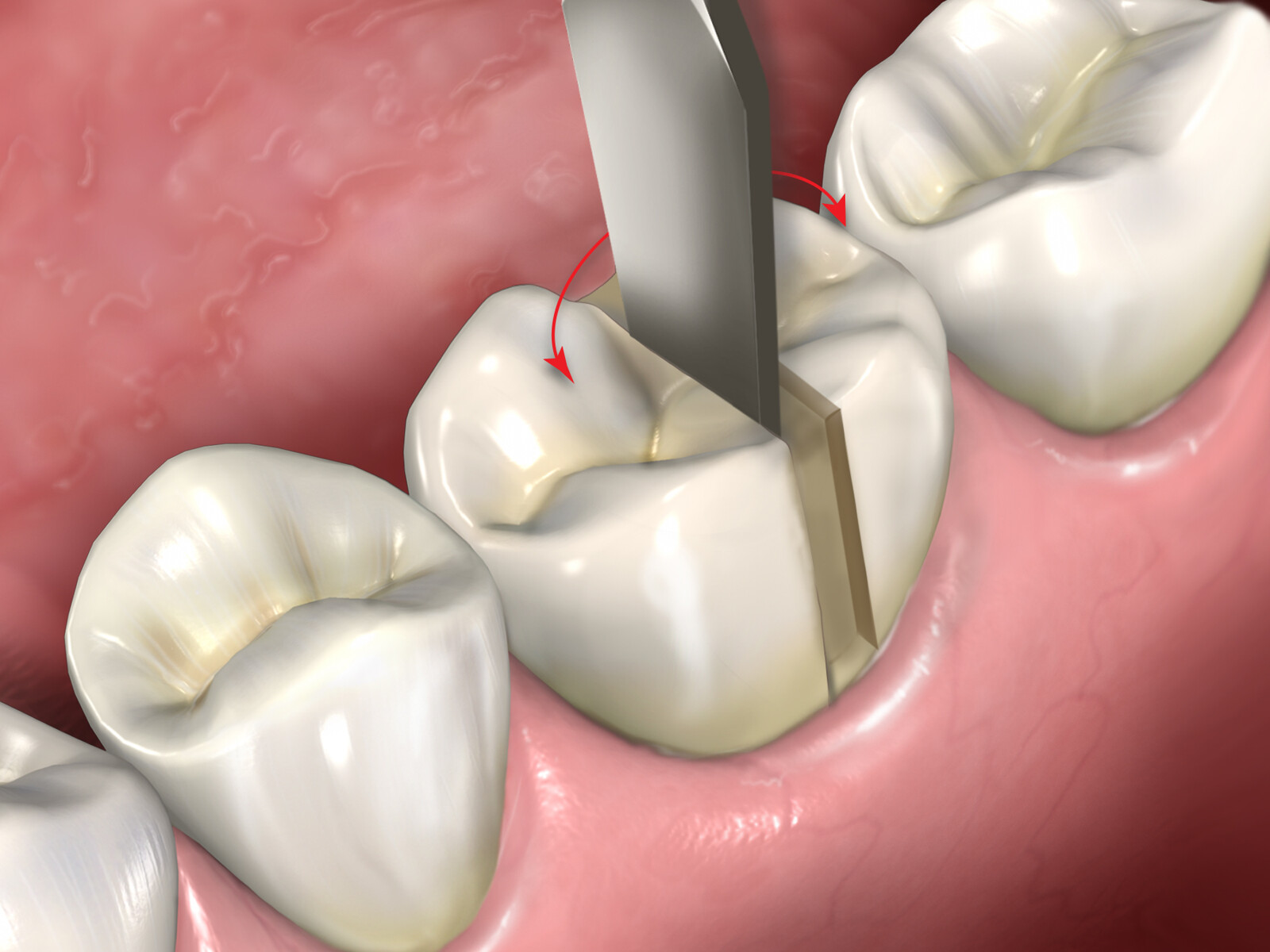 Eliminating the challenges of crown removal or endodontic access ...