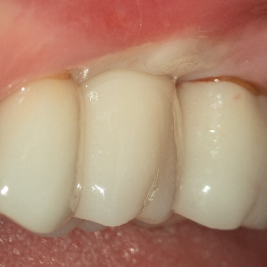 The transparent gingiva project IV