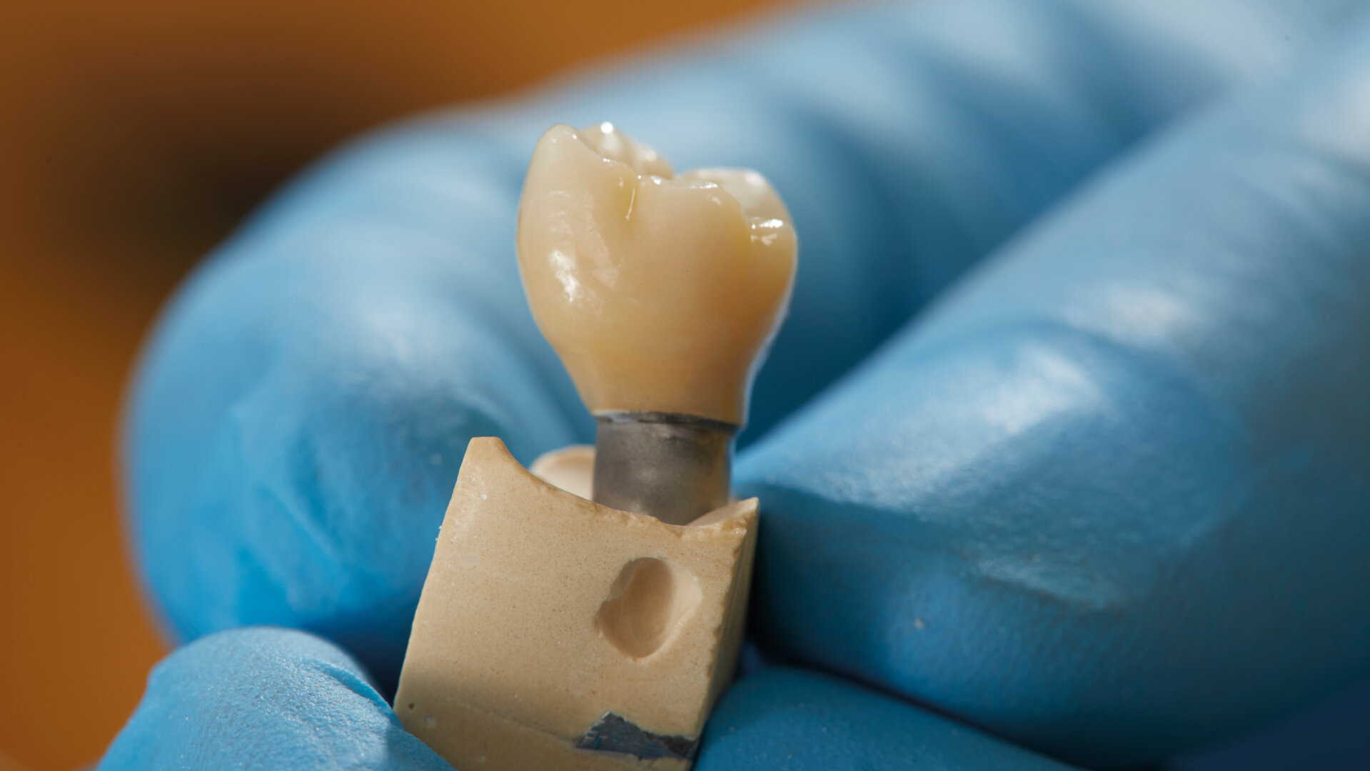 PANAVIA: 40 years of success in adhesive luting