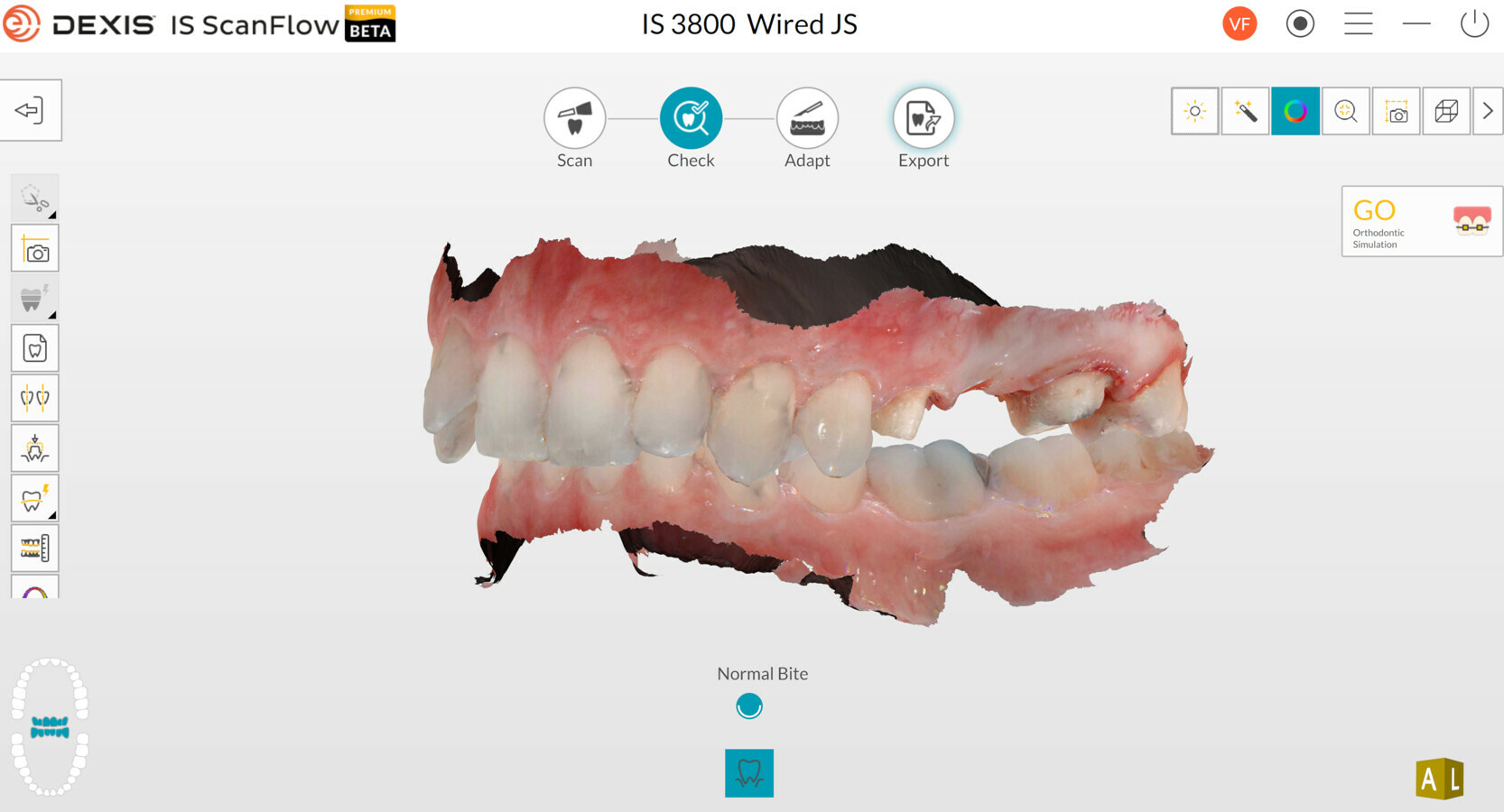 A three-unit bridge restoration of a fractured ceramic crown