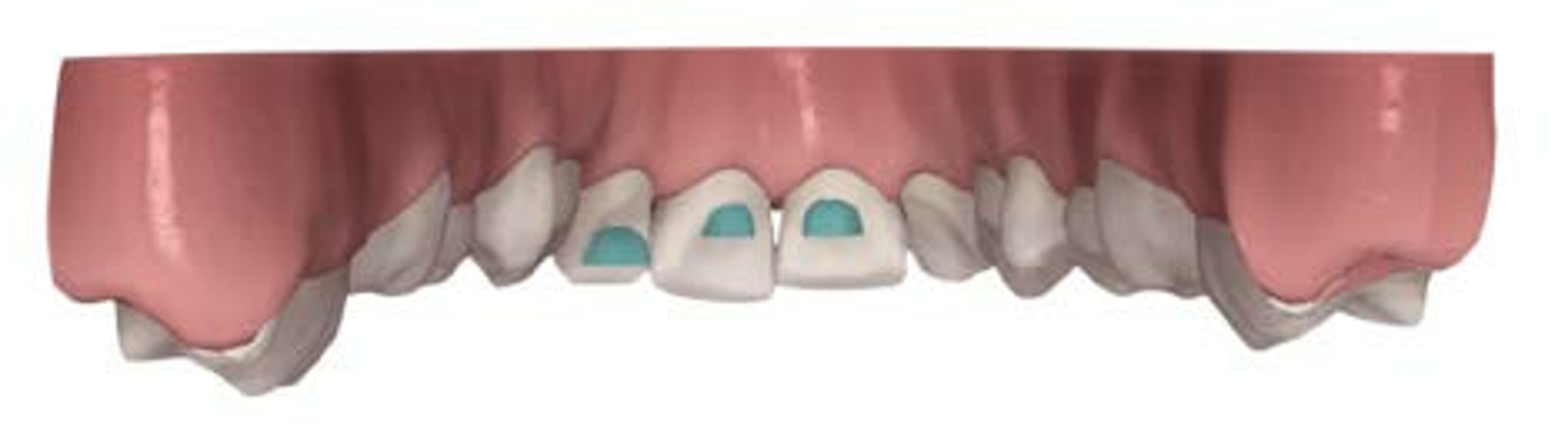 Proper curve of Spee levelling