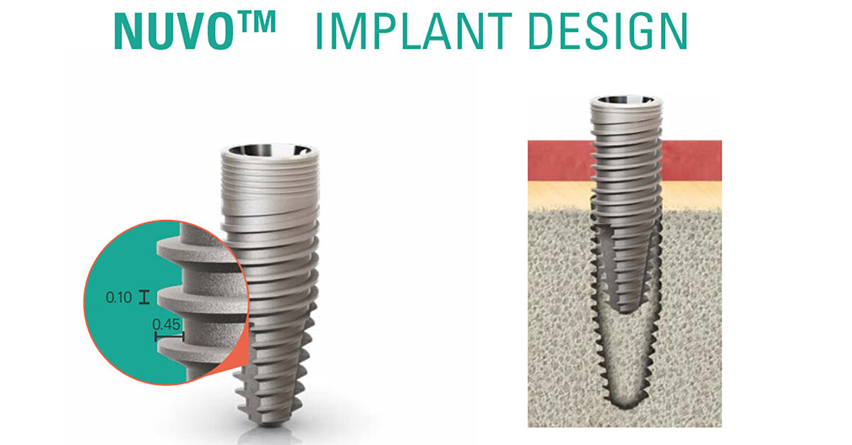 DT News - MEA - Tapered Implants: Designing original to boost primer ...