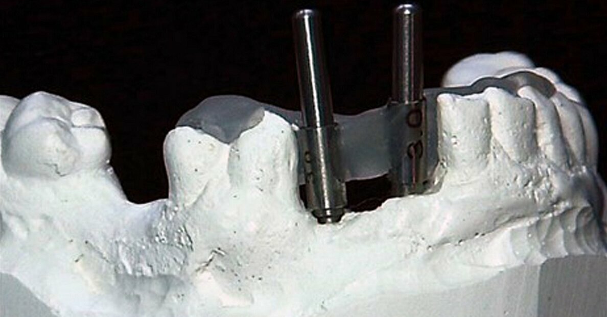An in-office-fabricated implant surgical guide corrected using CBCT