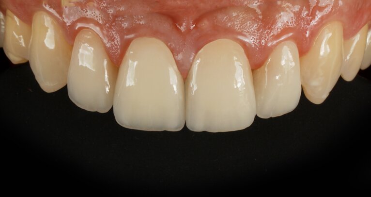 Expert discusses modern ceramic restorations in free webinar