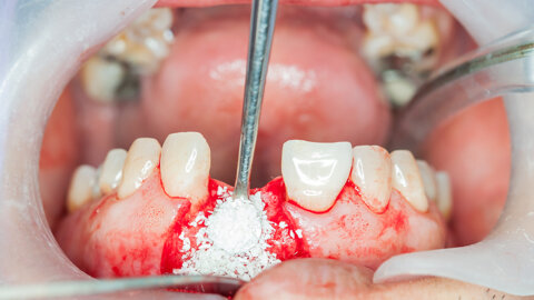Graphy presents first direct 3D-printed aligner