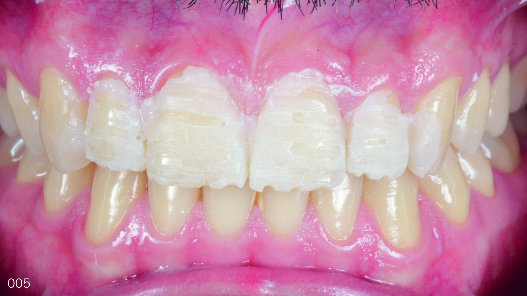 DT News - International - Extremely minimally invasive mock-up-guided ...