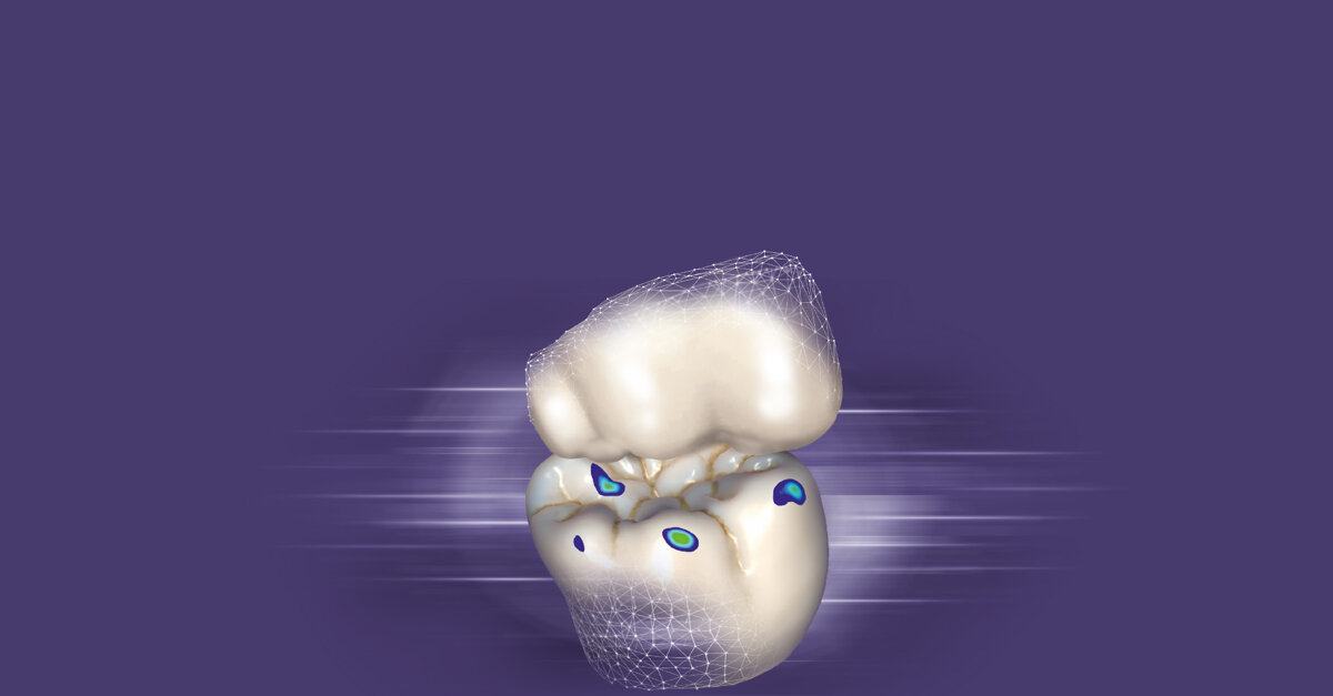 DT News - International - Reduce design time with exocad’s DentalCAD 3. ...