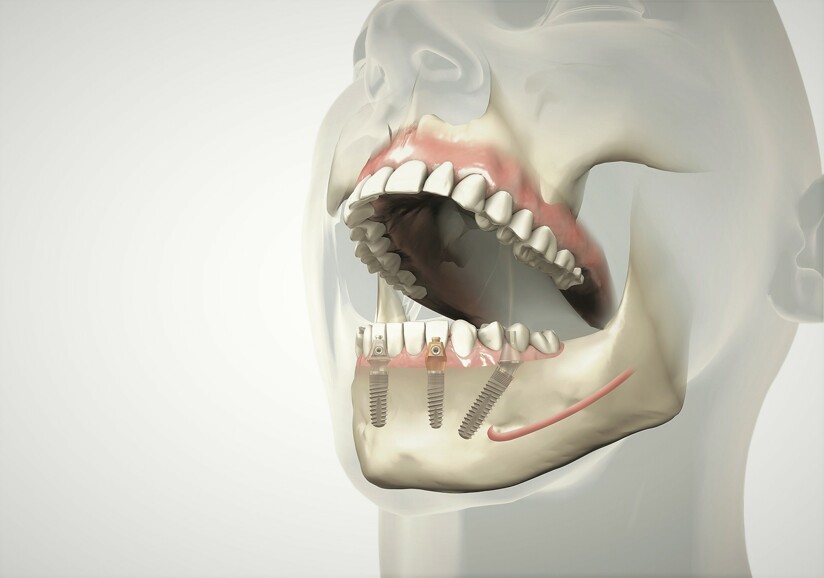 bredent – SKY fast & fixed