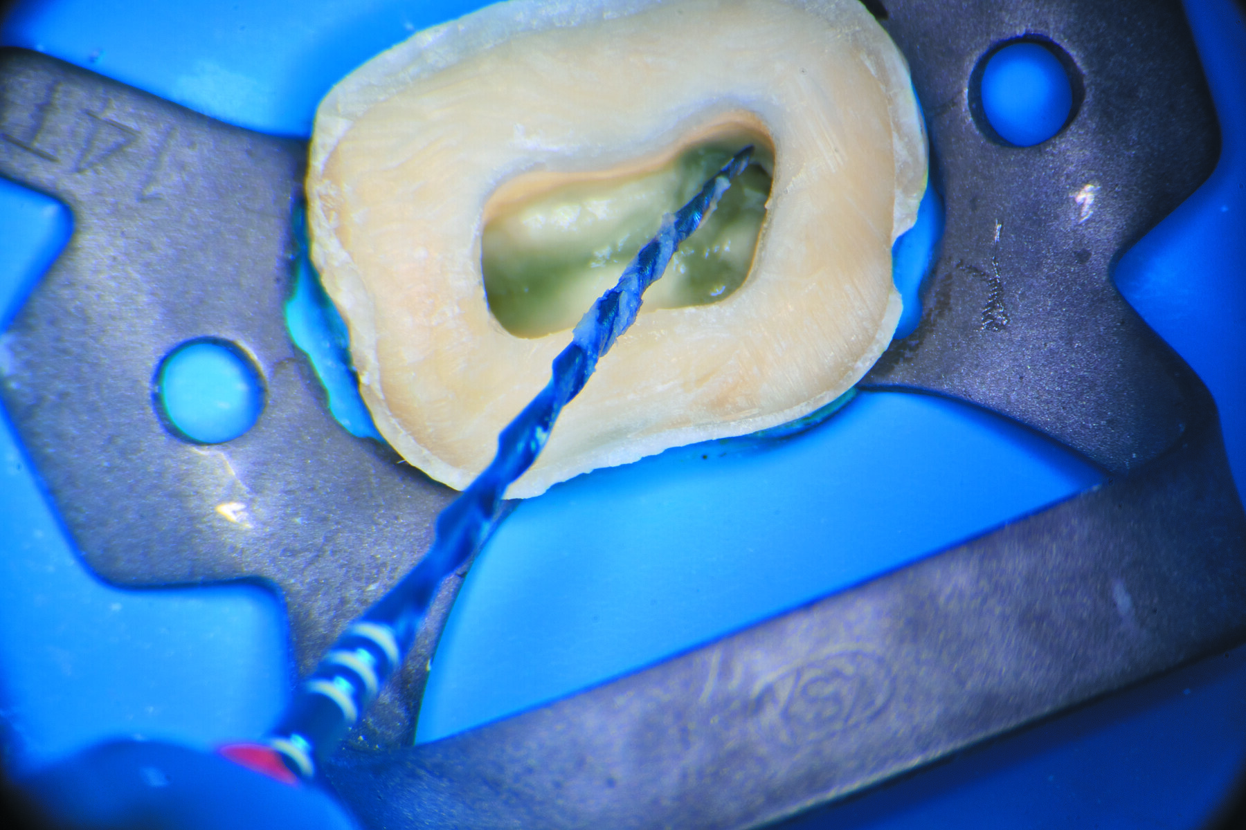 New Approach To Root Canal Preparation The Inout Technique