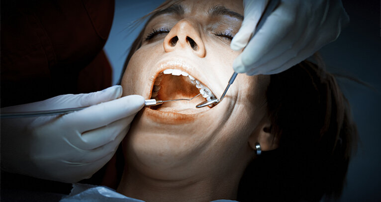 Glass hybrid technology: An alternative to dental amalgam