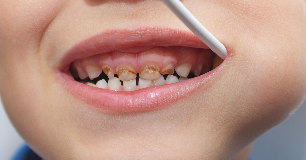 Study shows silver diamine fluoride helps children's teeth