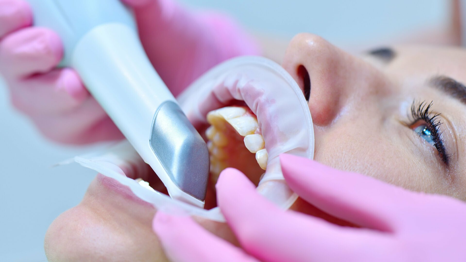 Dental News - Study finds intra-oral scanner viable alternative to ...