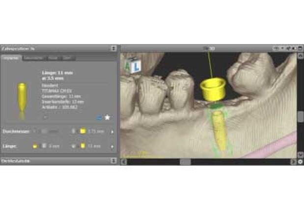 Neodent implant library now available in coDiagnostiX Guided Surgery ...