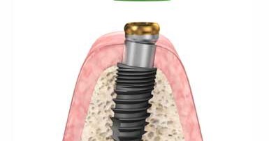 Stern SNAP Angled Overdenture Implant Abutment System