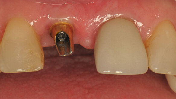 The Hiossen ETIII Implant System: A coordinated approach to esthetic ...