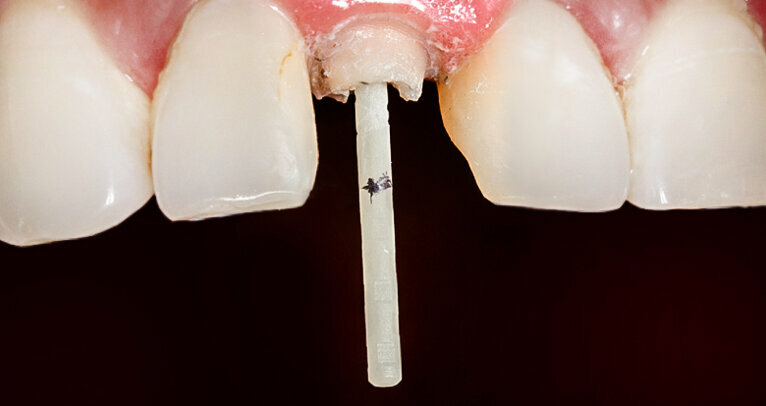 Fibre posts and tooth reinforcement: Evidence in the literature