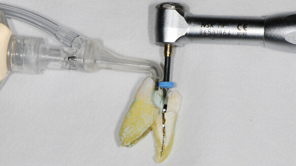 Dental News - Improving endodontic success through use of the EndoVac ...